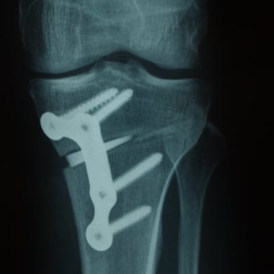 Ostéotomie tibiale - genou | Dr Jacquel